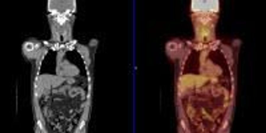 New Imaging Scans Track down Persistent Cancer Cells | Lab Manager