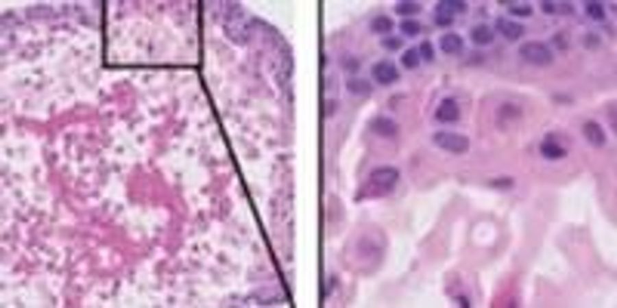 Testing Therapies on Mini-Tumors of Head and Neck Cancer | Lab Manager