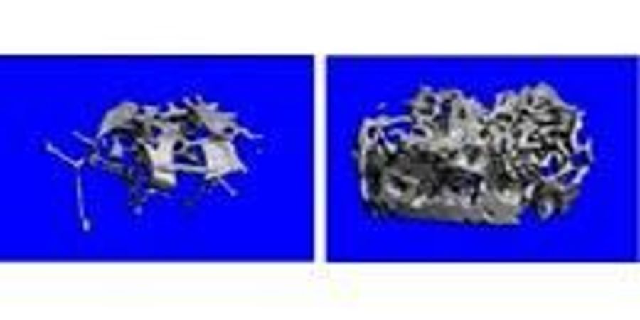 Ultra-Sturdy Bones, with a Surprising Origin, Suggest New Osteoporosis ...