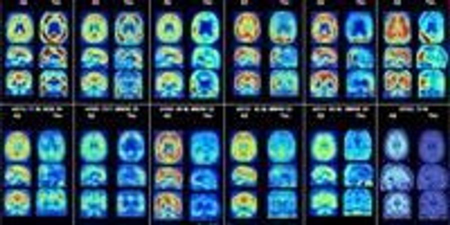Promising Diagnostic Tool Identified for Alzheimer's Disease | Lab Manager