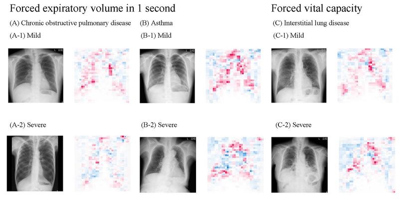 Highly Accurate AI Model Can Estimate Lung Function Just by Using Chest X-rays | Lab Manager