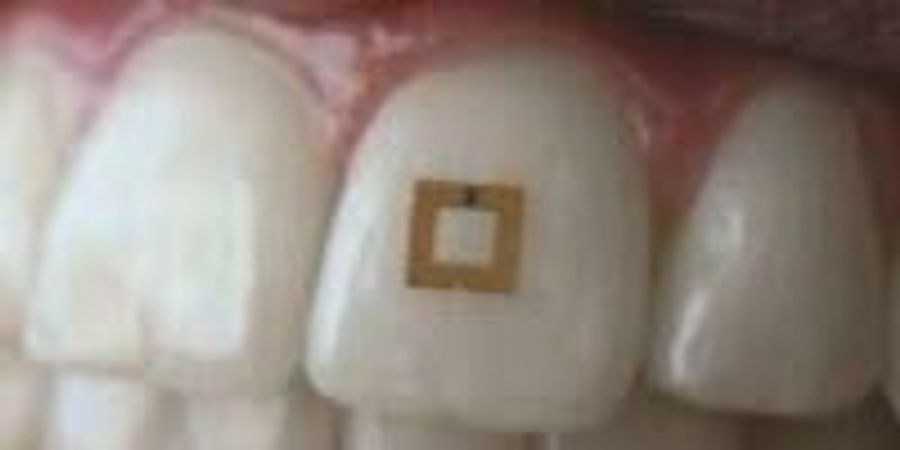 Scientists Develop Tiny Tooth-Mounted Sensors That Can Track What You ...