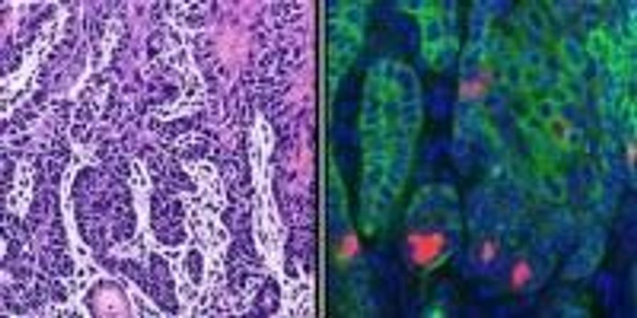 Targeting Cancer Stem Cells Improves Treatment Effectiveness and ...