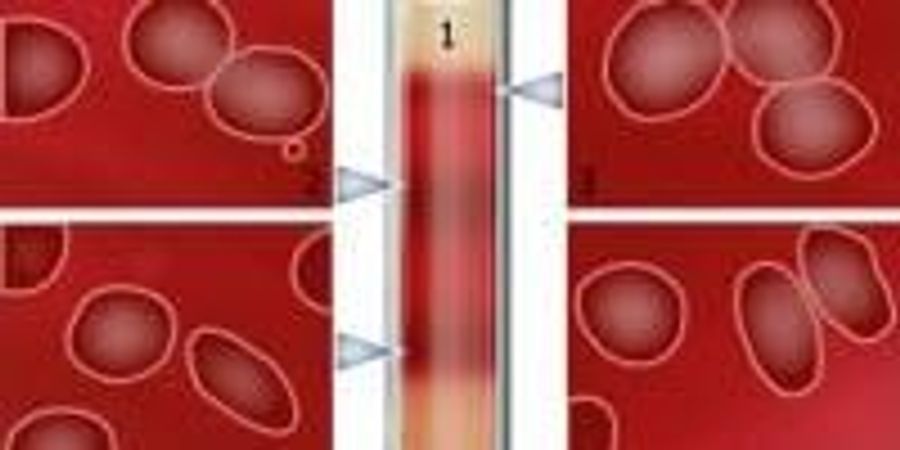 Discovery Could Help Treatments for Sickle Cell Disease | Lab Manager