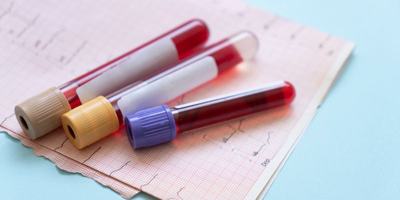 Blood Test May Rule Out Future Dementia Risk | Lab Manager